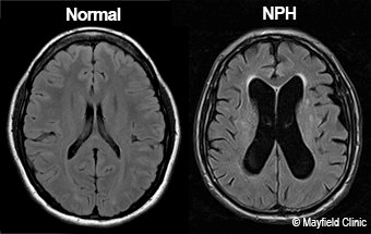 Normal Pressure Hydrocephalus | Briz Brain & Spine