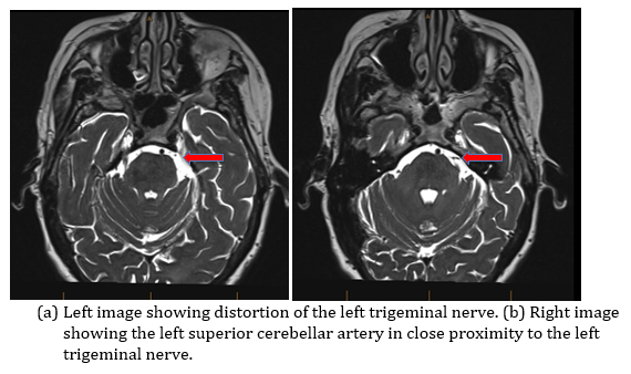 Case Study: Microvascular decompression of the trigeminal nerve - Briz ...